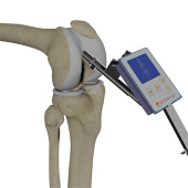 Knee Replacement Surgery Encinitas | OrthAlign Technology Carlsbad